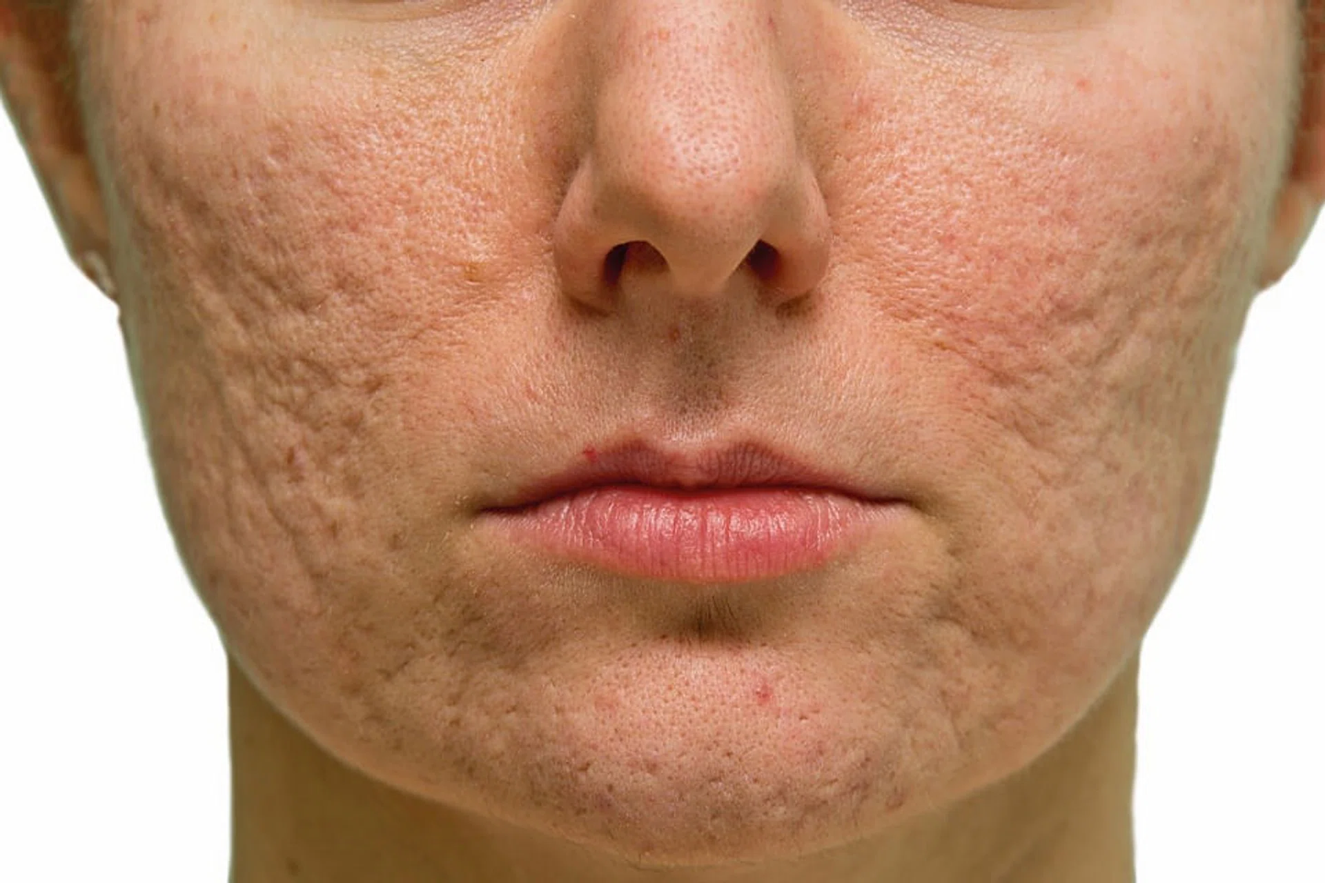 Treating acne scars - The Business Times