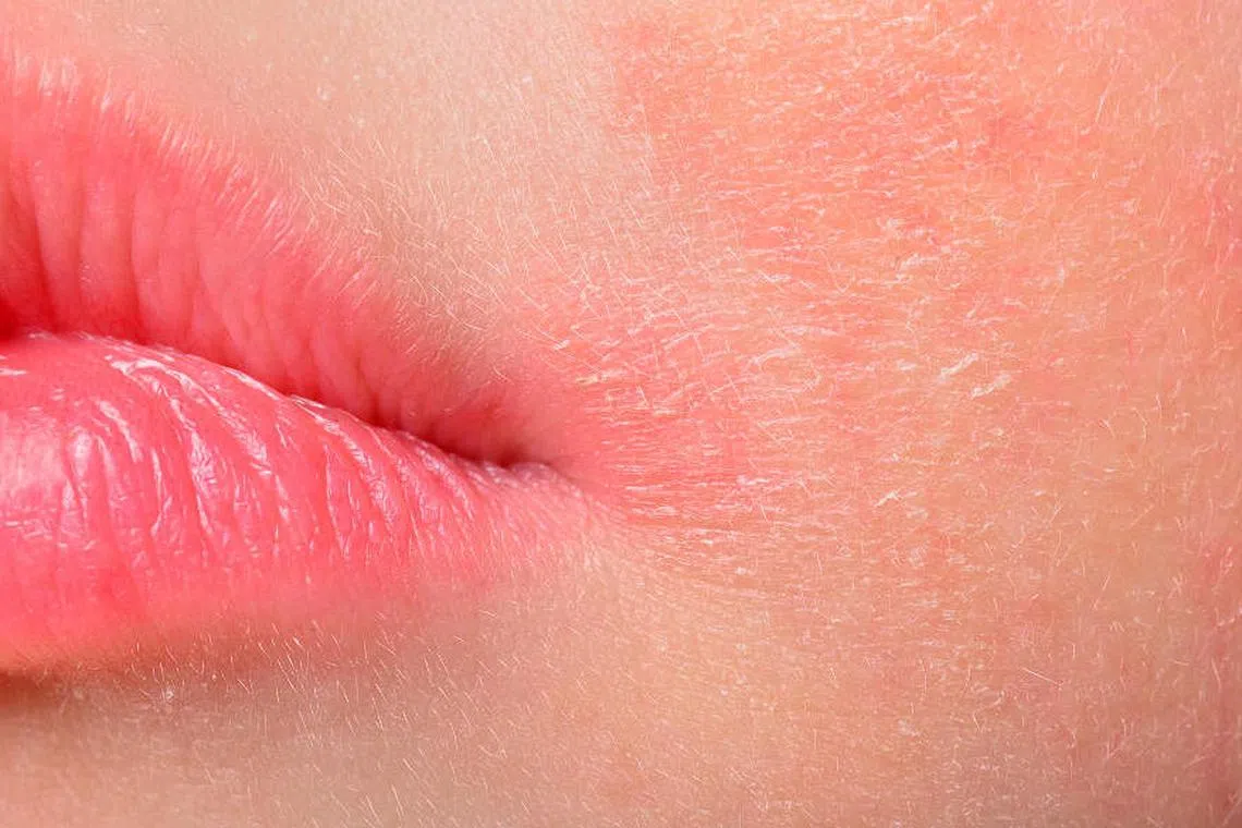 Suffer from psoriasis? Here's how to manage it - Her World Singapore ...