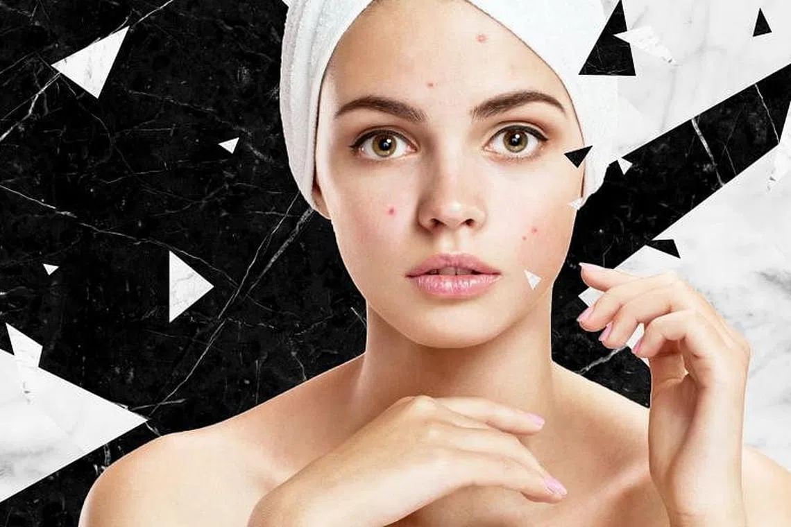 My 6-month Accutane Journey - Her World Singapore | Her World Singapore