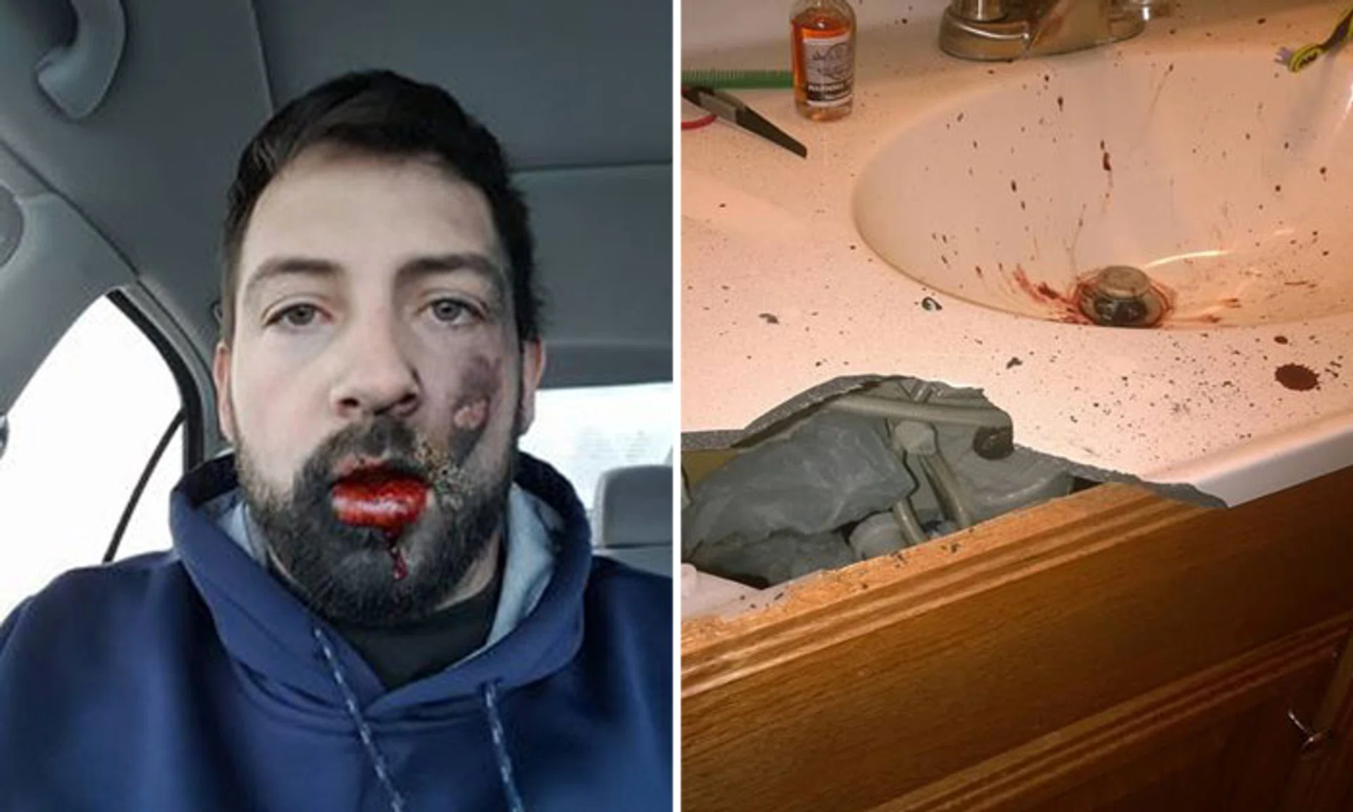 US man loses 7 teeth, receives second-degree..., Latest News - STOMP