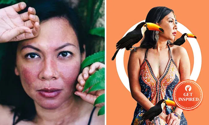 Malaysian girl called 'Two-face' due to her complexion proves 'flaws ...