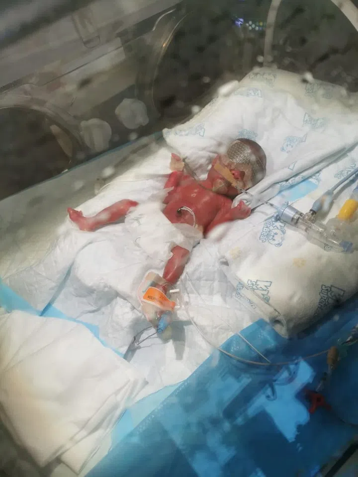 Baby born with underdeveloped brain and lungs, parents crowdfunding for ...