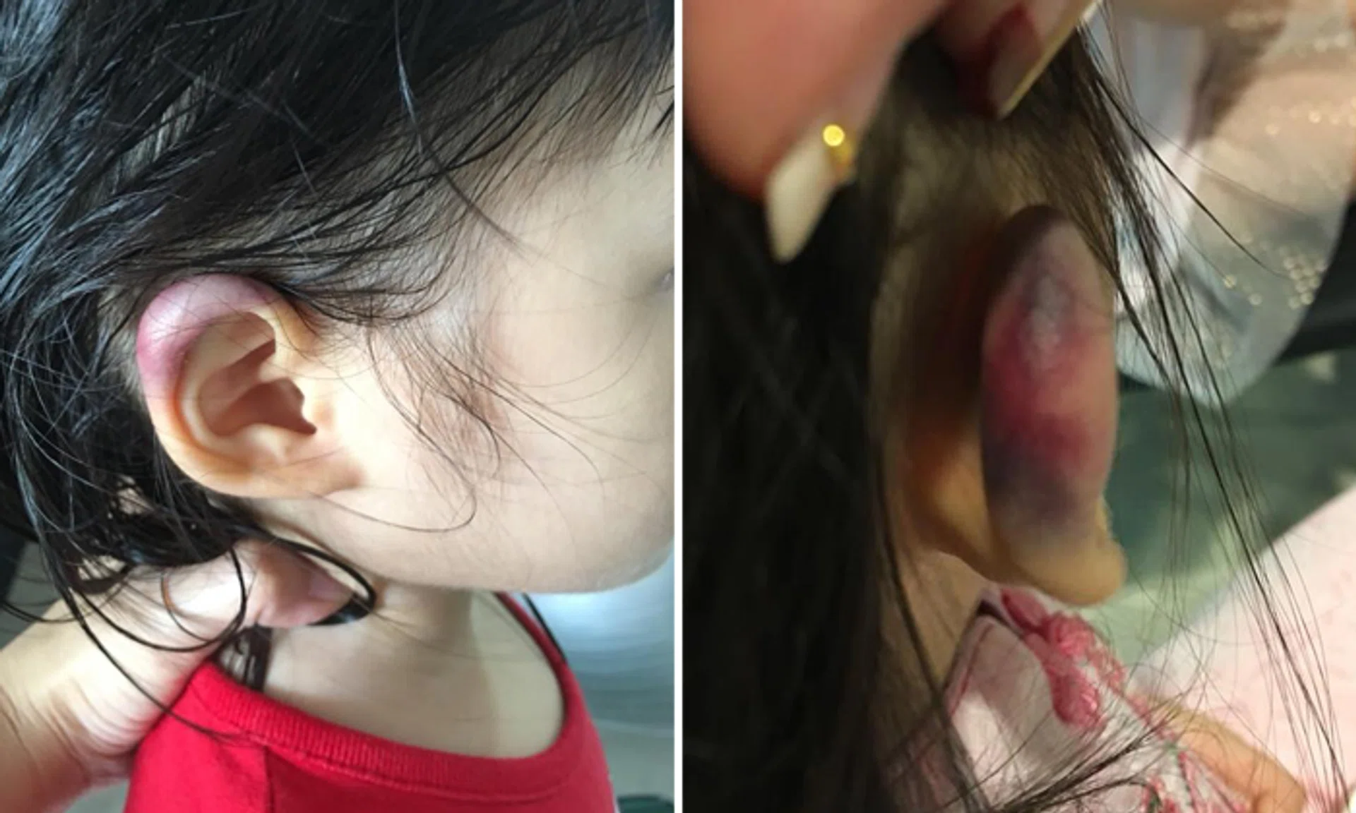 Kindergarten responds to incident about bruises found on 3-year-old girl's ear | STOMP