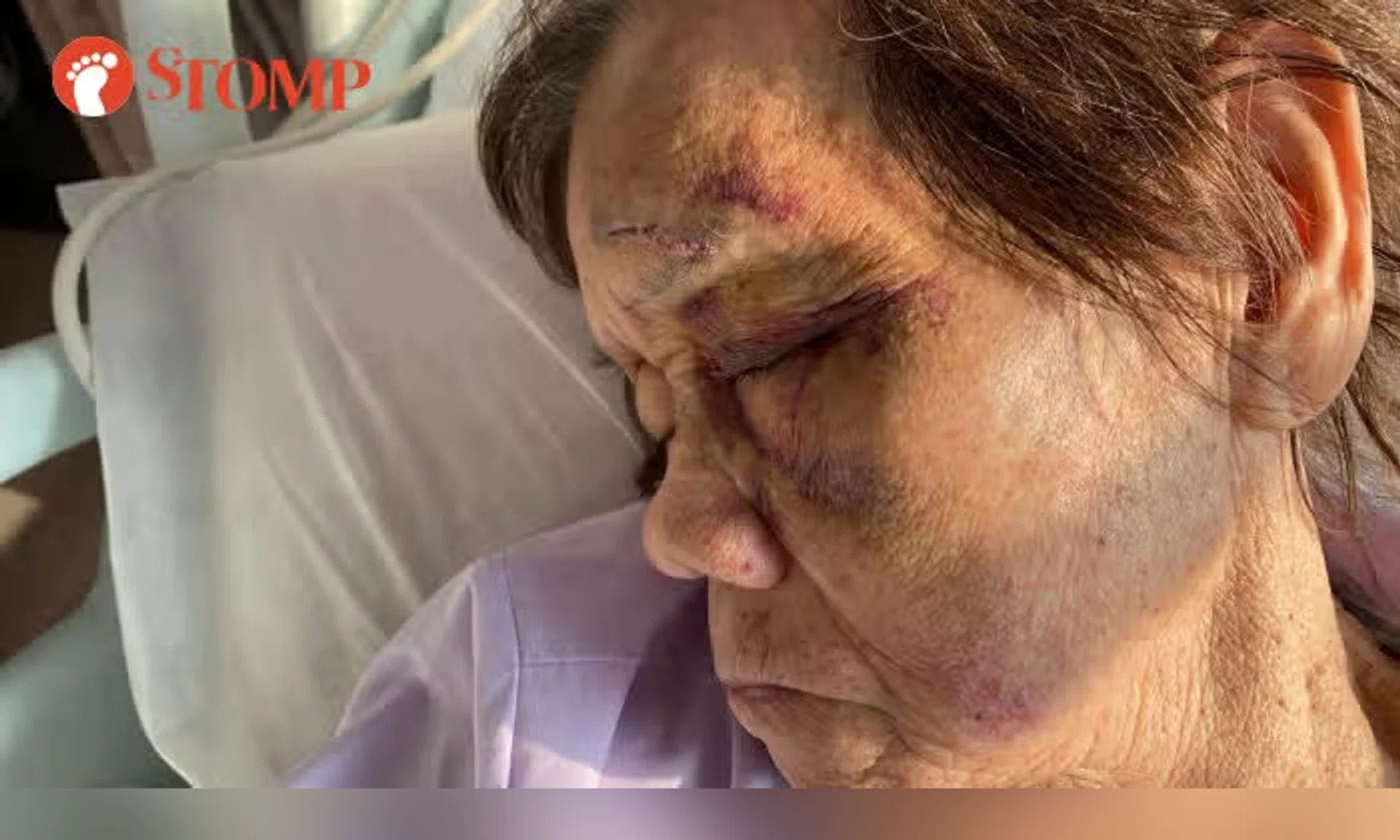 Elderly woman who fell on face in transitional care facility in 2024 ...