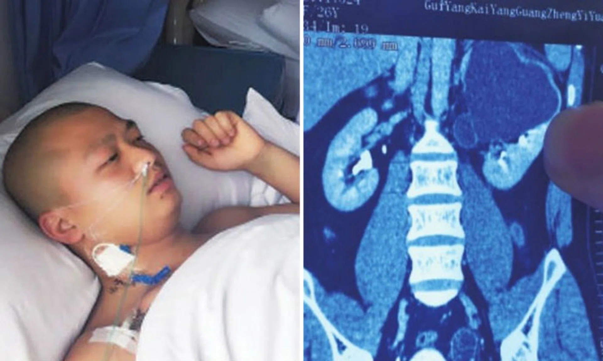 Chinese man discovers he has four kidneys..., Latest News - STOMP