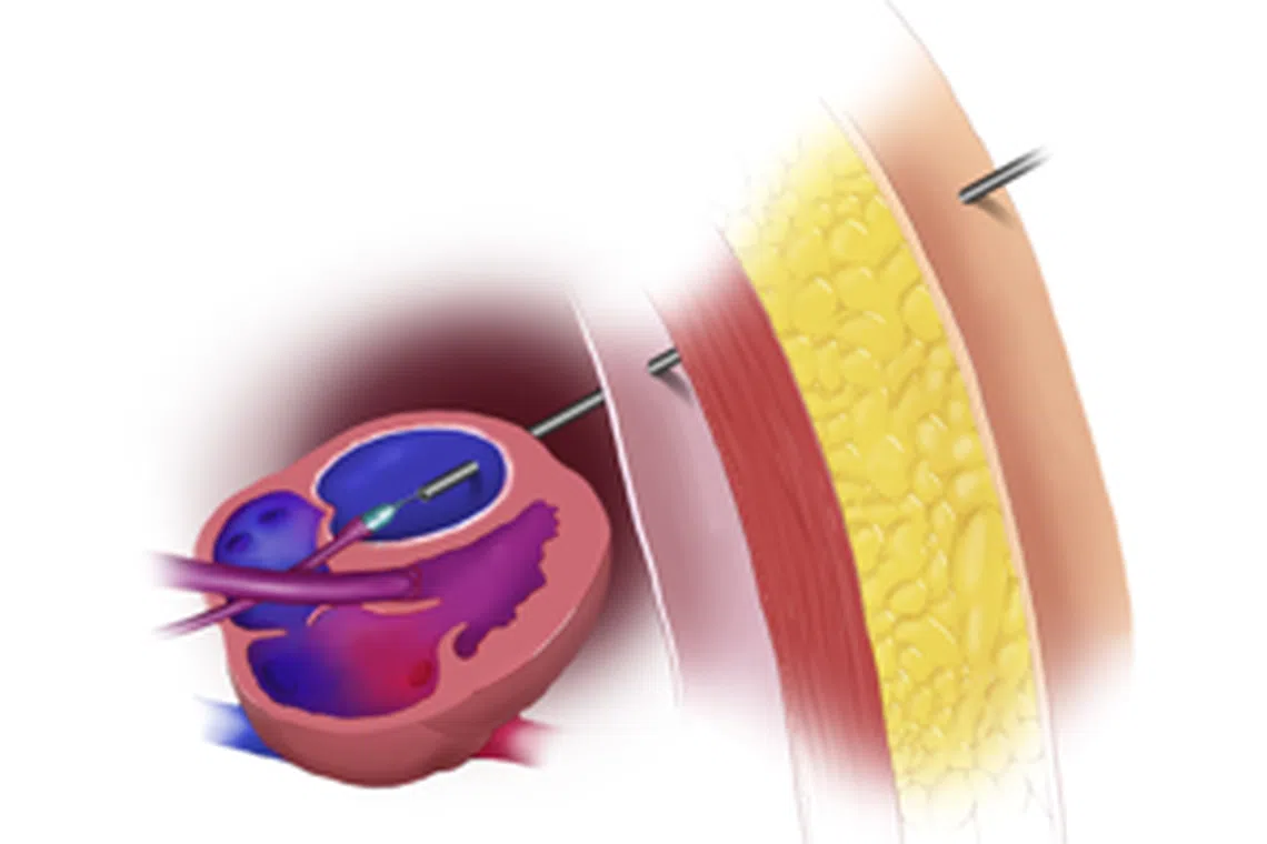 Doctors perform complex, rare surgery on grape-size heart of foetus ...
