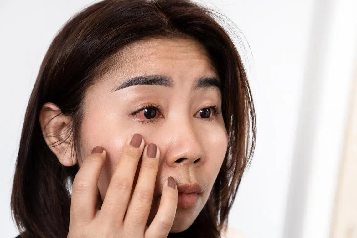 What causes dry, red eyes in Singapore and when to worry | The Straits ...