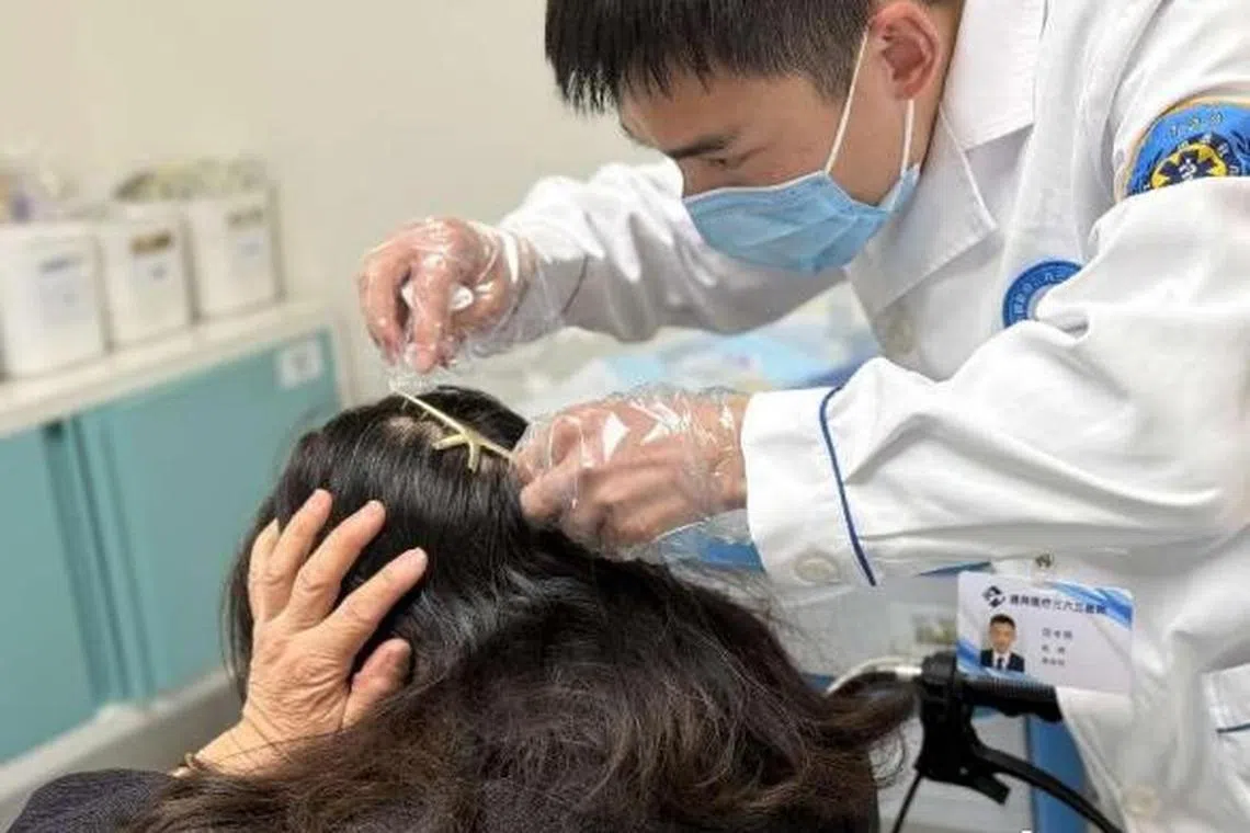 Hair claw clip pierces woman’s head after traffic accident in Chengdu ...