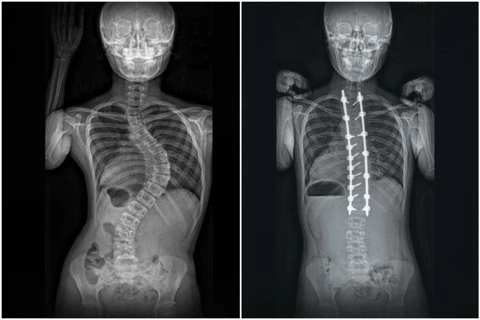 More teen girls in Singapore needing surgery to correct curvature of ...