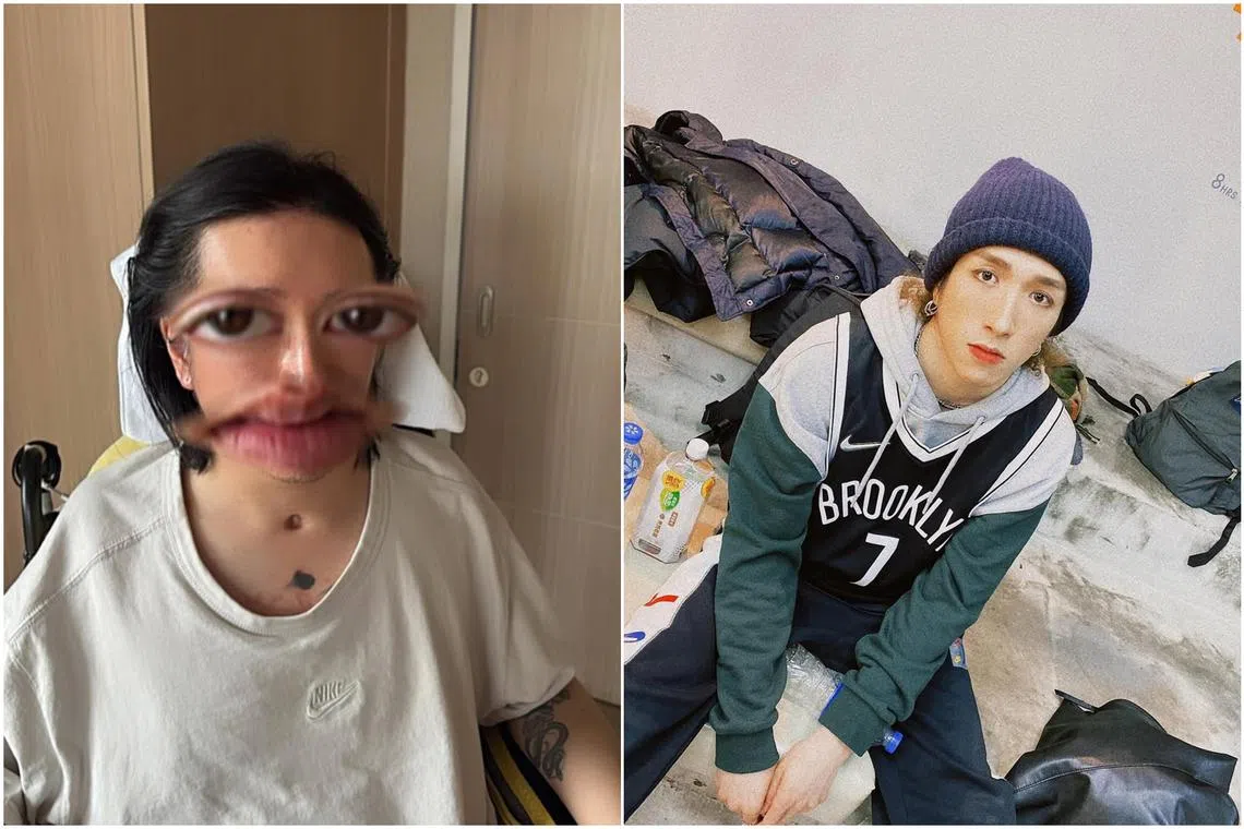 Injured dancer Lee Kai Yin shares first filtered photo of face since ...