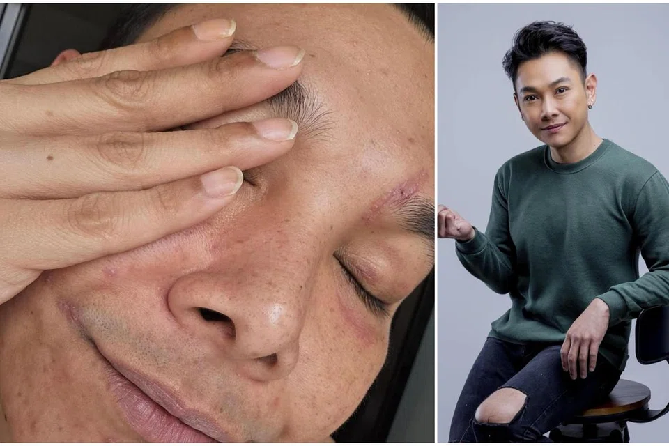 Actor Ryan Lian shares photos of scarred face after slashing attack ...