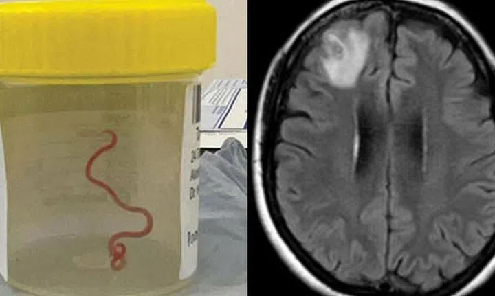 'Alive and wriggling': Live worm found in woman's brain in Australia ...
