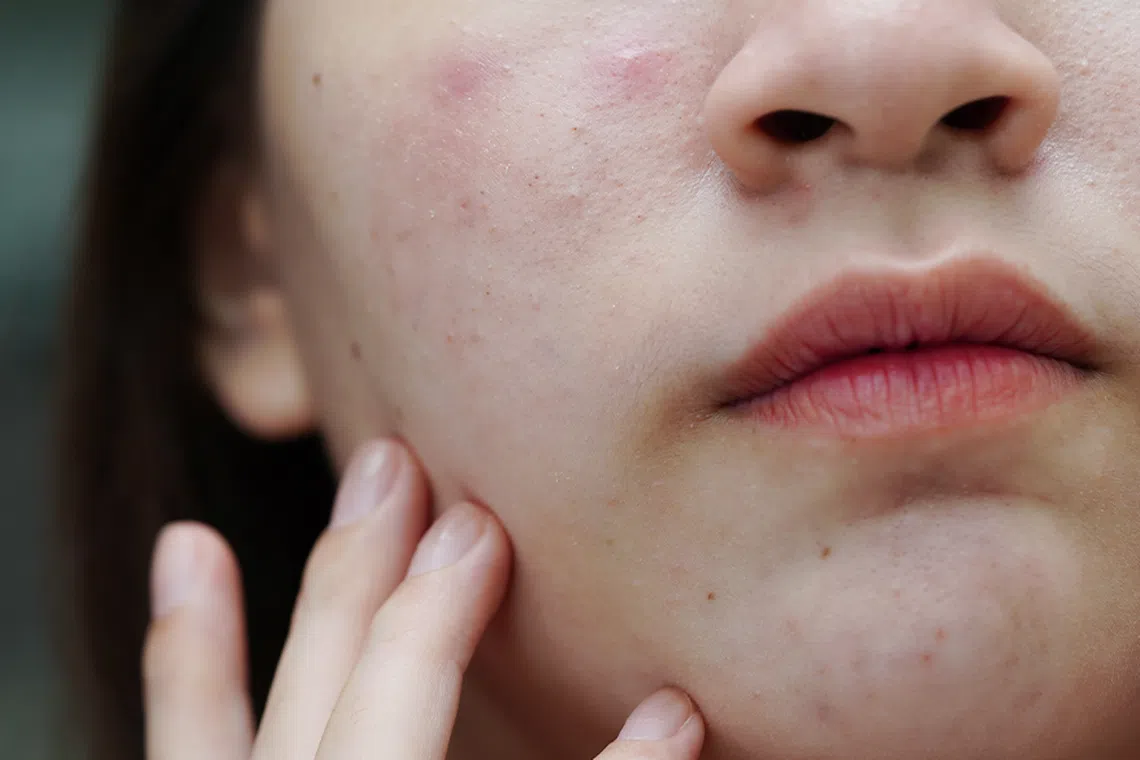 A Five-Step Guide To Exfoliation For Sensitive Skin | The Singapore ...