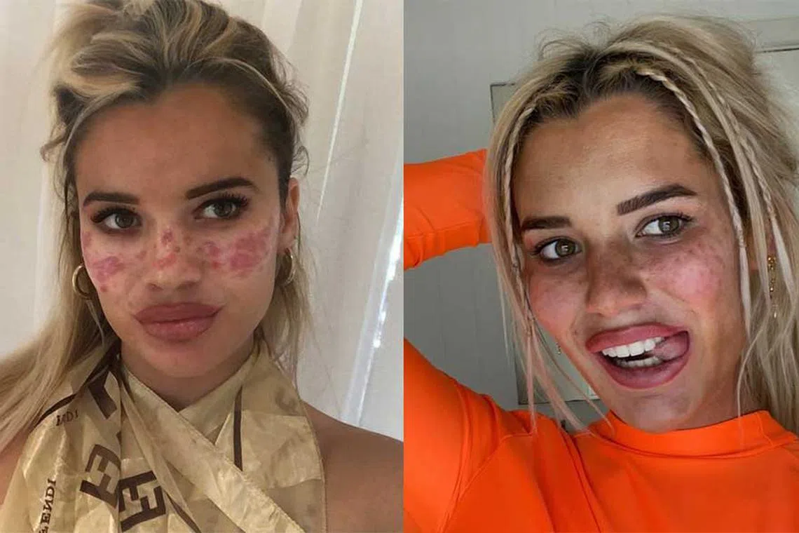 This TikToker Got Her Face Scarred From Trying The Freckle Trend - The ...